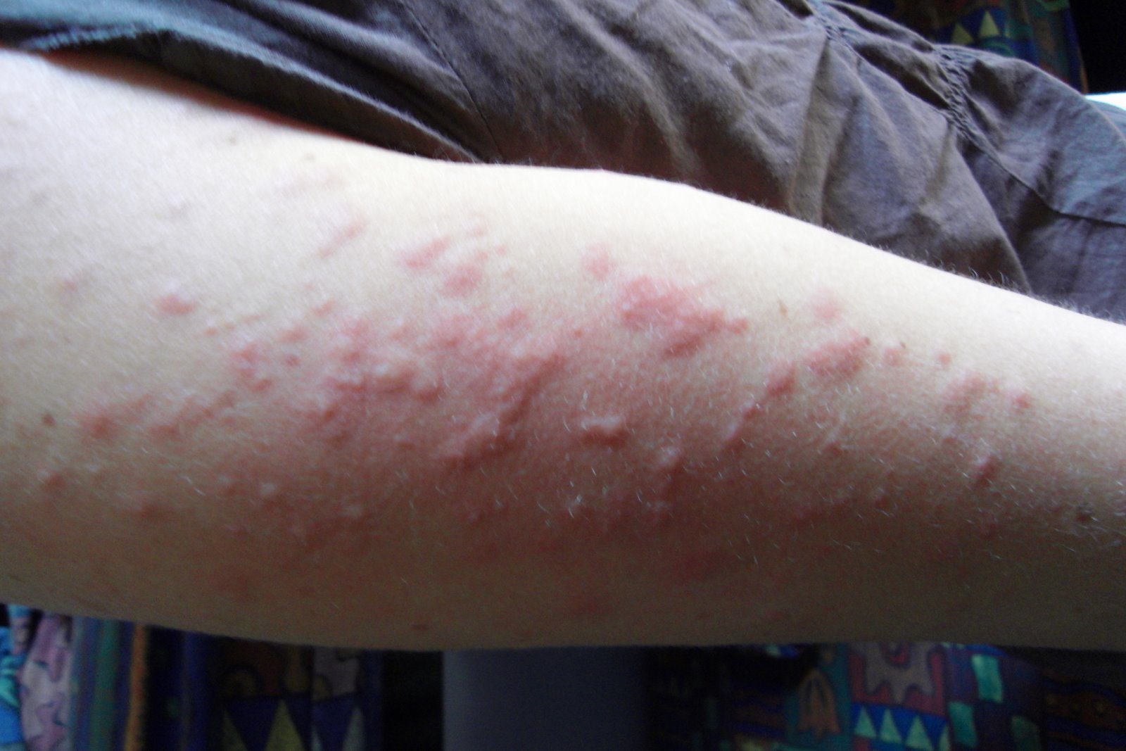 Bed Bugs Alert –Symptoms – NYC Bed Bug Manual for New York City and ...
